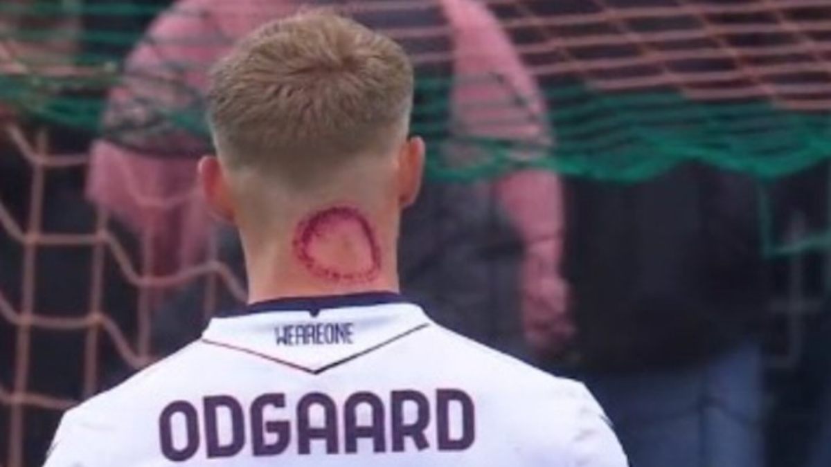 ¿Un chupetón, mordida zombie? La curiosa marca de Odgaard, que se hace ...